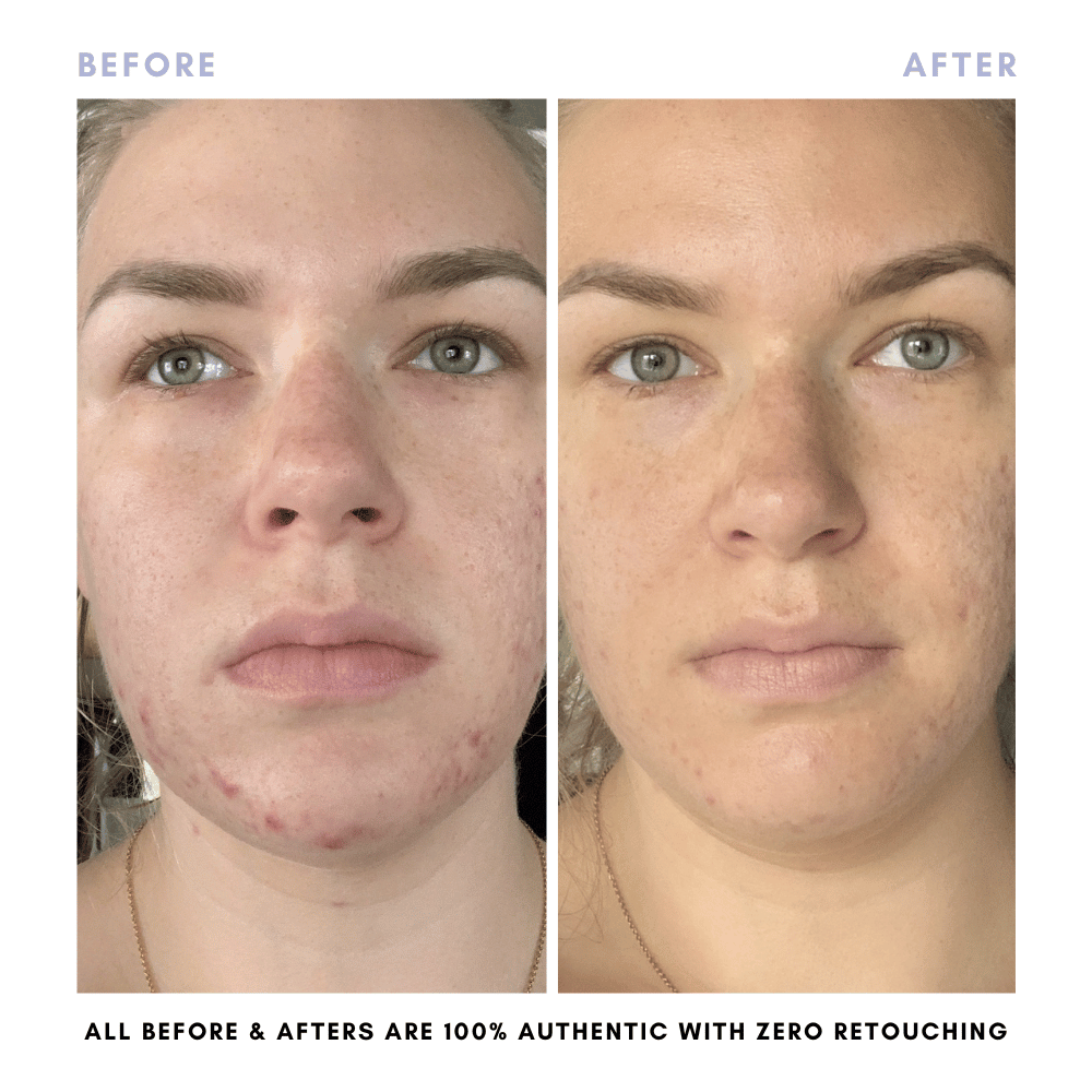 Affordable Acne Skin Care | Balancing Oil - Clover by Clove + Hallow