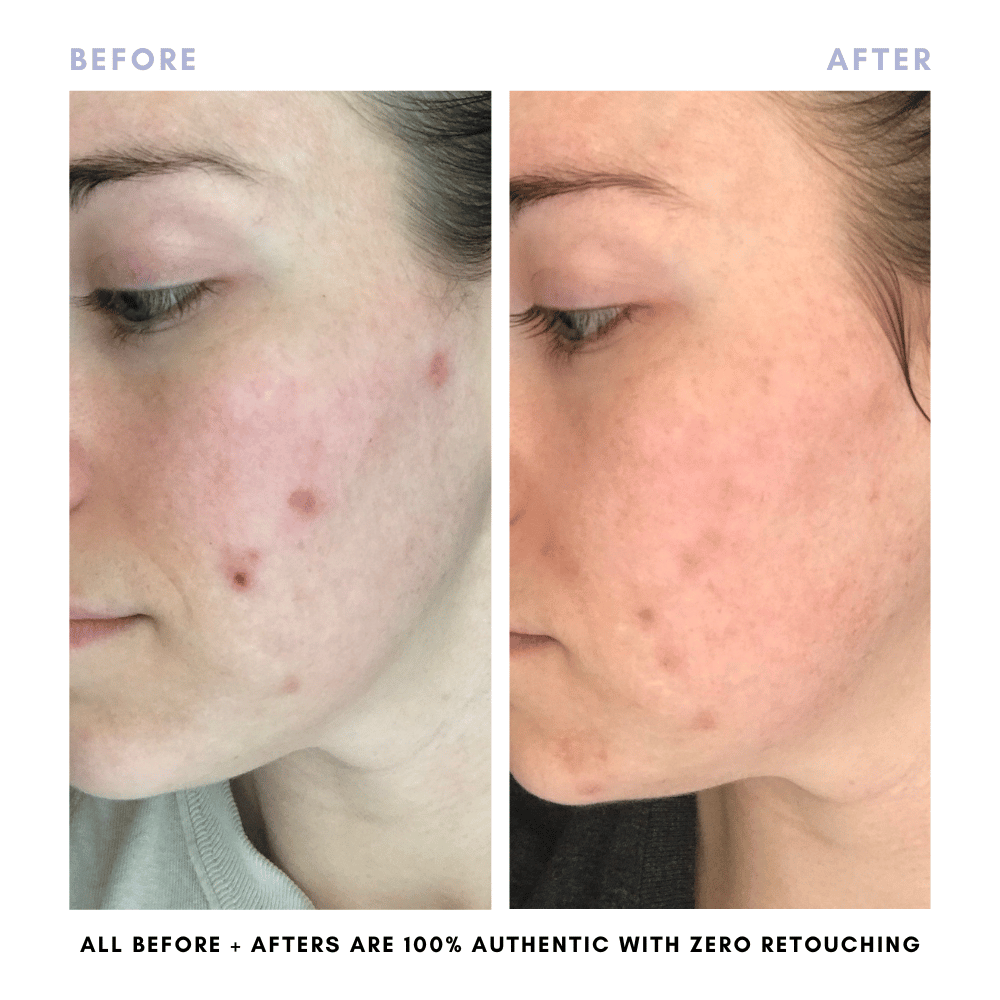 Affordable Acne Skin Care | Balancing Oil - Clover by Clove + Hallow