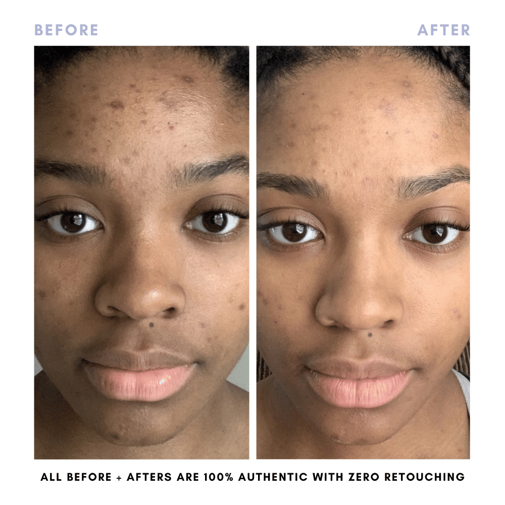 Affordable Acne Skin Care | Balancing Oil - Clover by Clove + Hallow